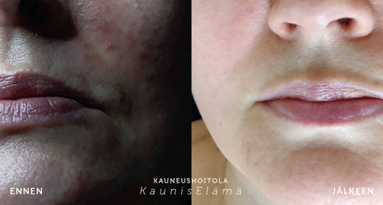 Ruusufinni hoitotulos - Kauneushoitola Kauniselämä Espoo